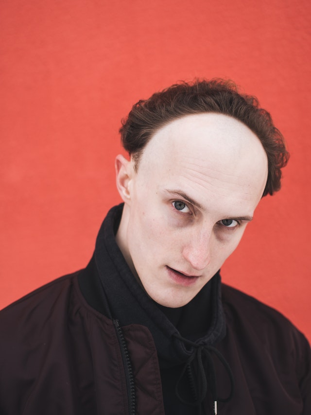 Receding Hairline: Causes, Treatments, and Prevention Strategies ...
